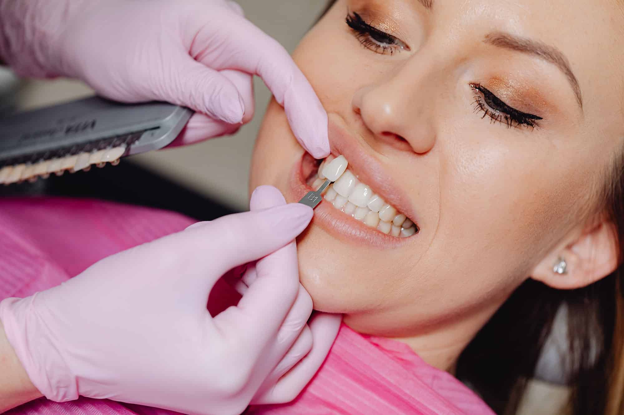 Top Questions to Ask Your Dentist Before Getting Veneers